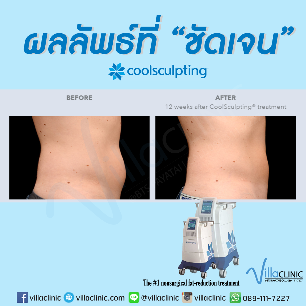 Coolsculpting – Villa Clinic