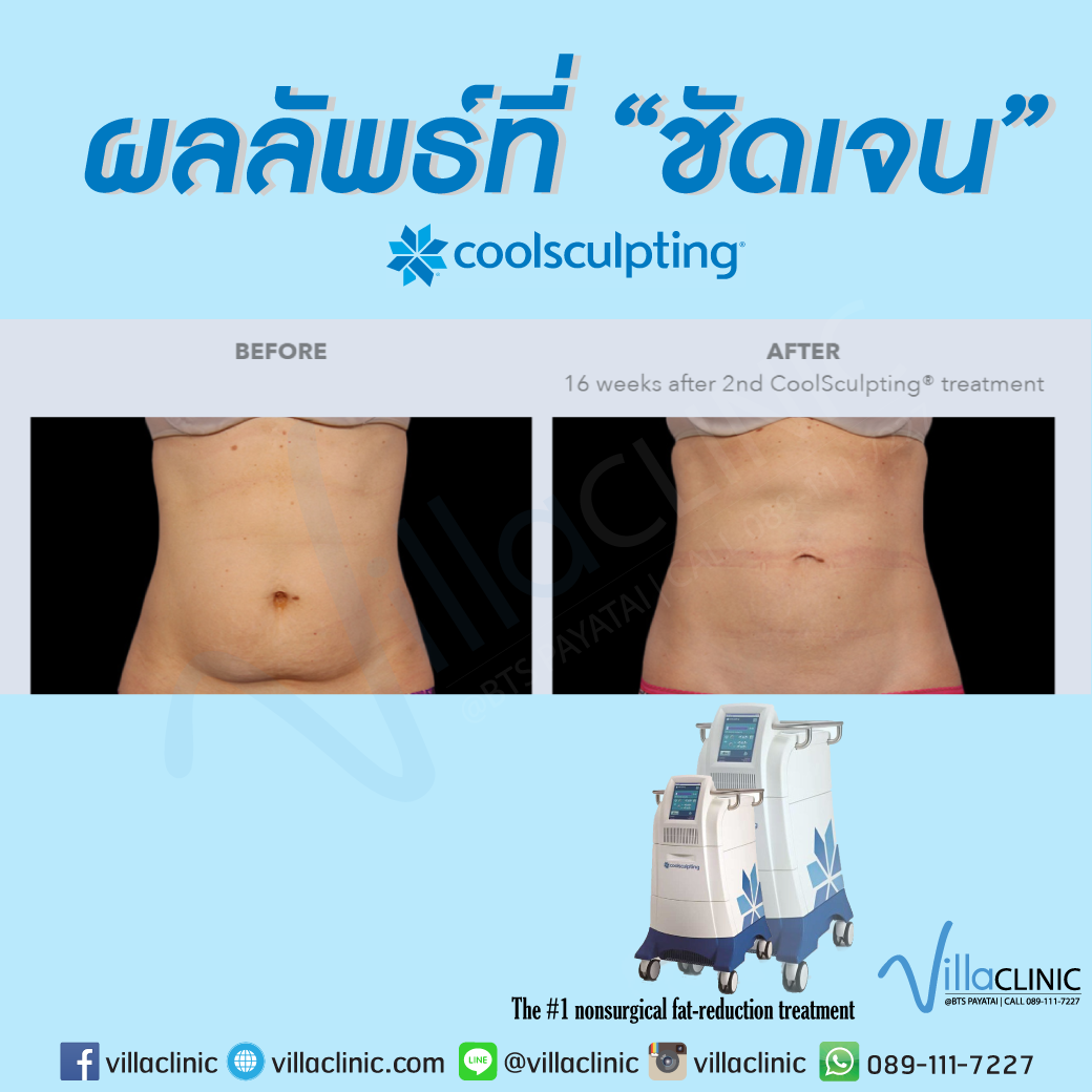 Coolsculpting – Villa Clinic