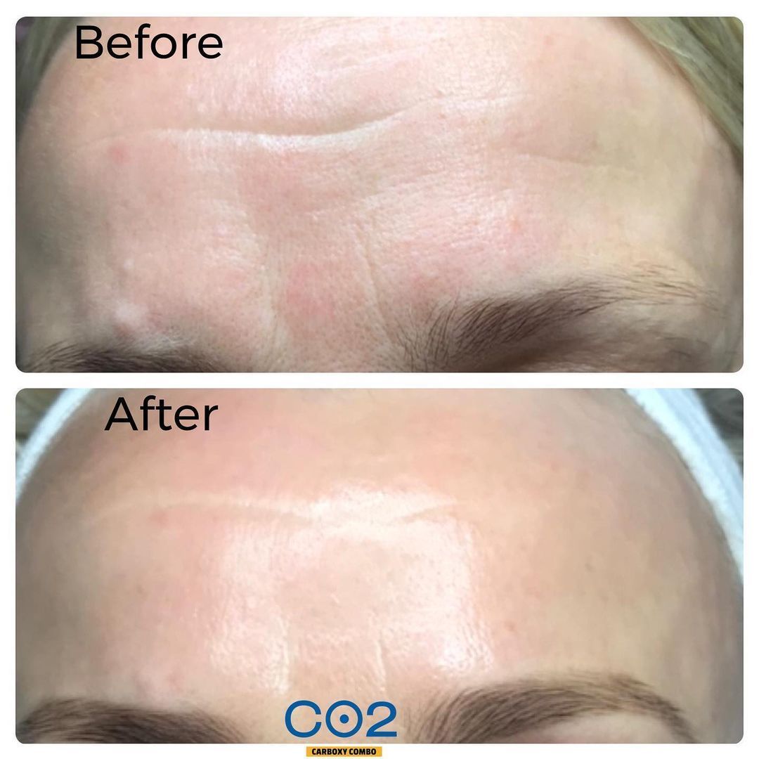 CO2 Lifting Gel (Carboxy Mask) – Villa Clinic