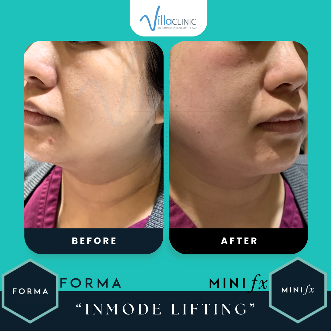 INMODE 2-STEP LIFTING – Villa Clinic