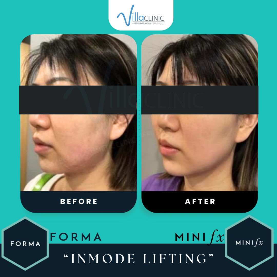 INMODE 2-STEP LIFTING – Villa Clinic